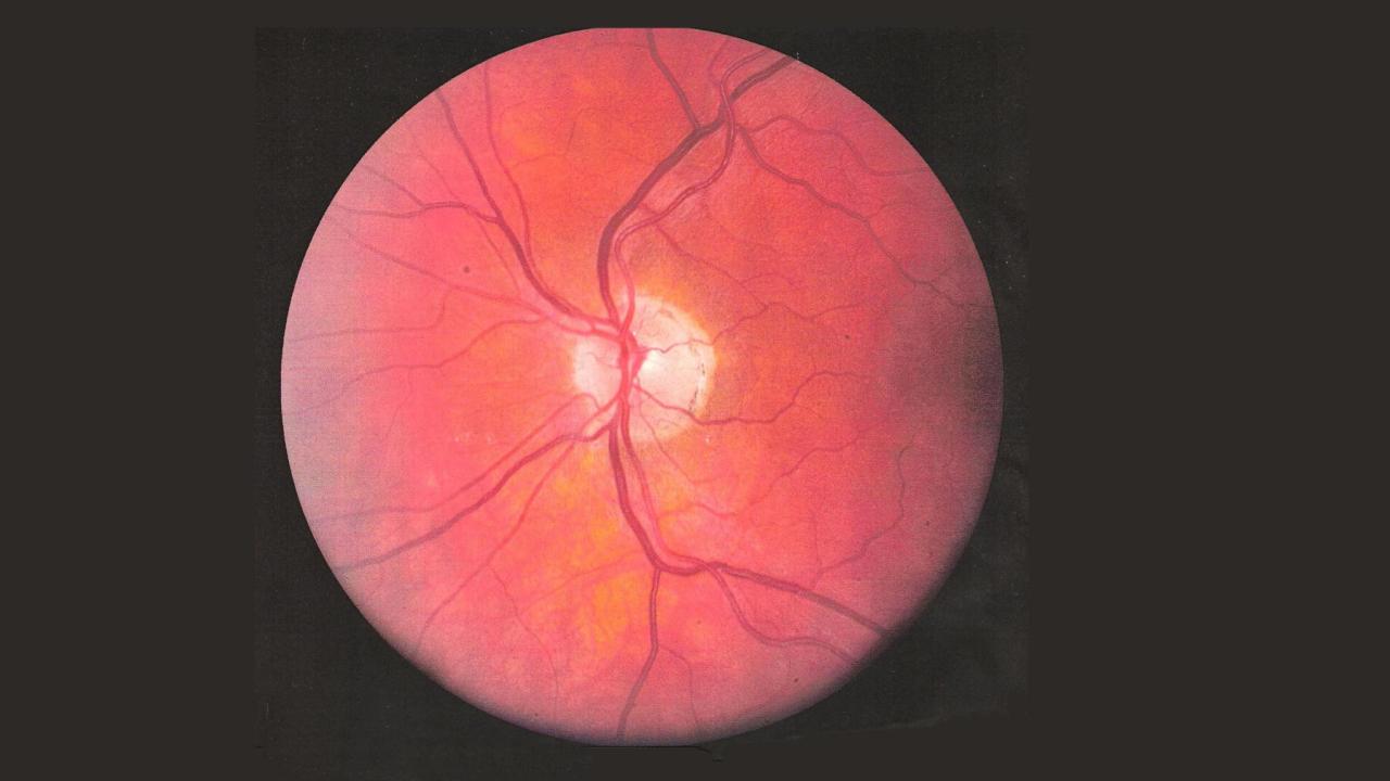 A review on retinal migraines: the structural changes that occur on the ...